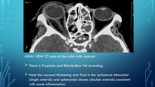 orbital c subperiosteal abscess and orbital contents | PPT | Free Download