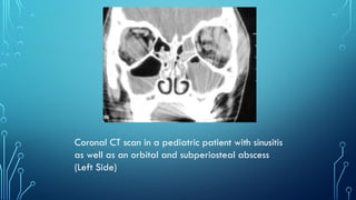 orbital c subperiosteal abscess and orbital contents | PPTX