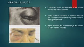 orrrbirbitalcellulitis-160628172354.pptx