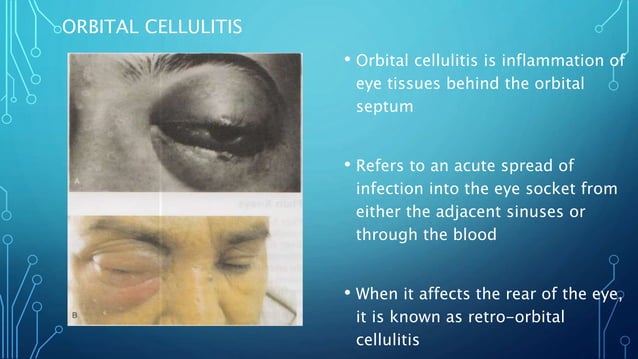 Orbital cellulitis | PPTX | Eye and Vision Conditions | Diseases and ...