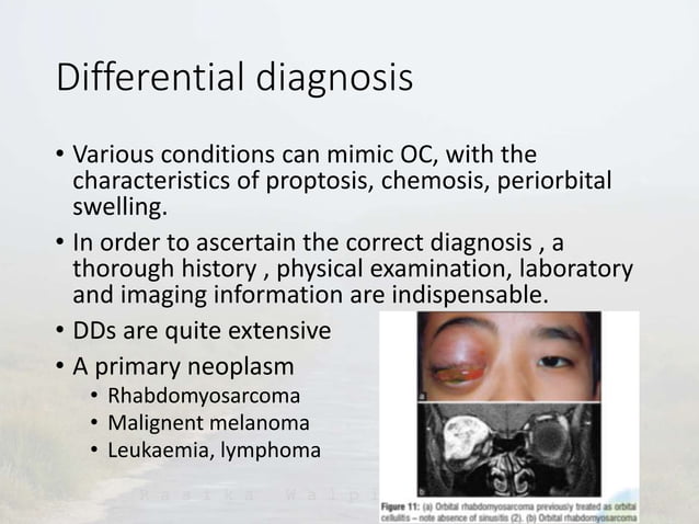 Orbital Cellulitis | PPT | Free Download