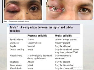 Preseptal Cellulitis Vs Orbital Cellulitis