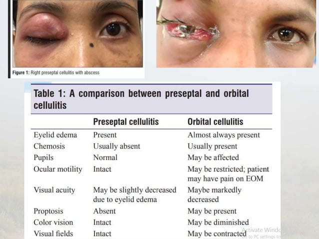 Orbital Cellulitis | PPT