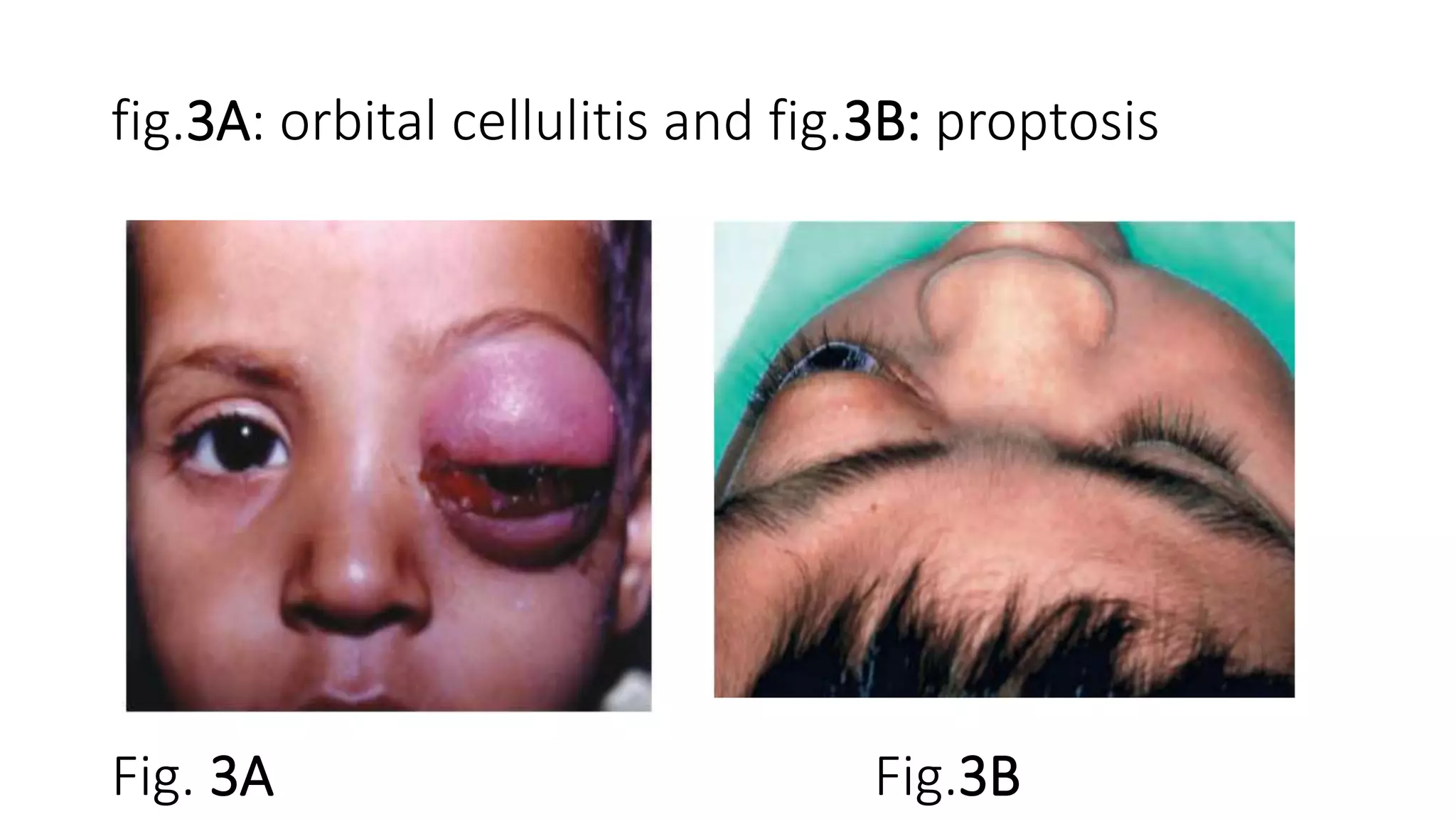 Orbital cellulitis | PPTX
