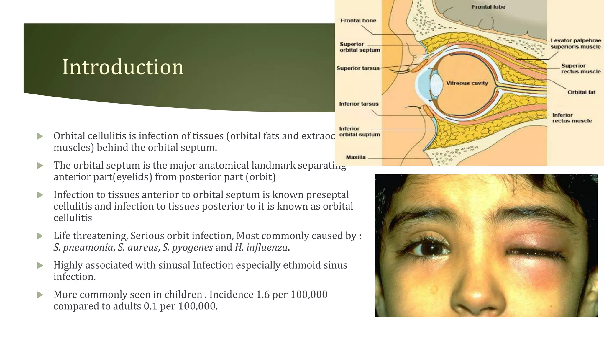 orbital cellulitis.pptx