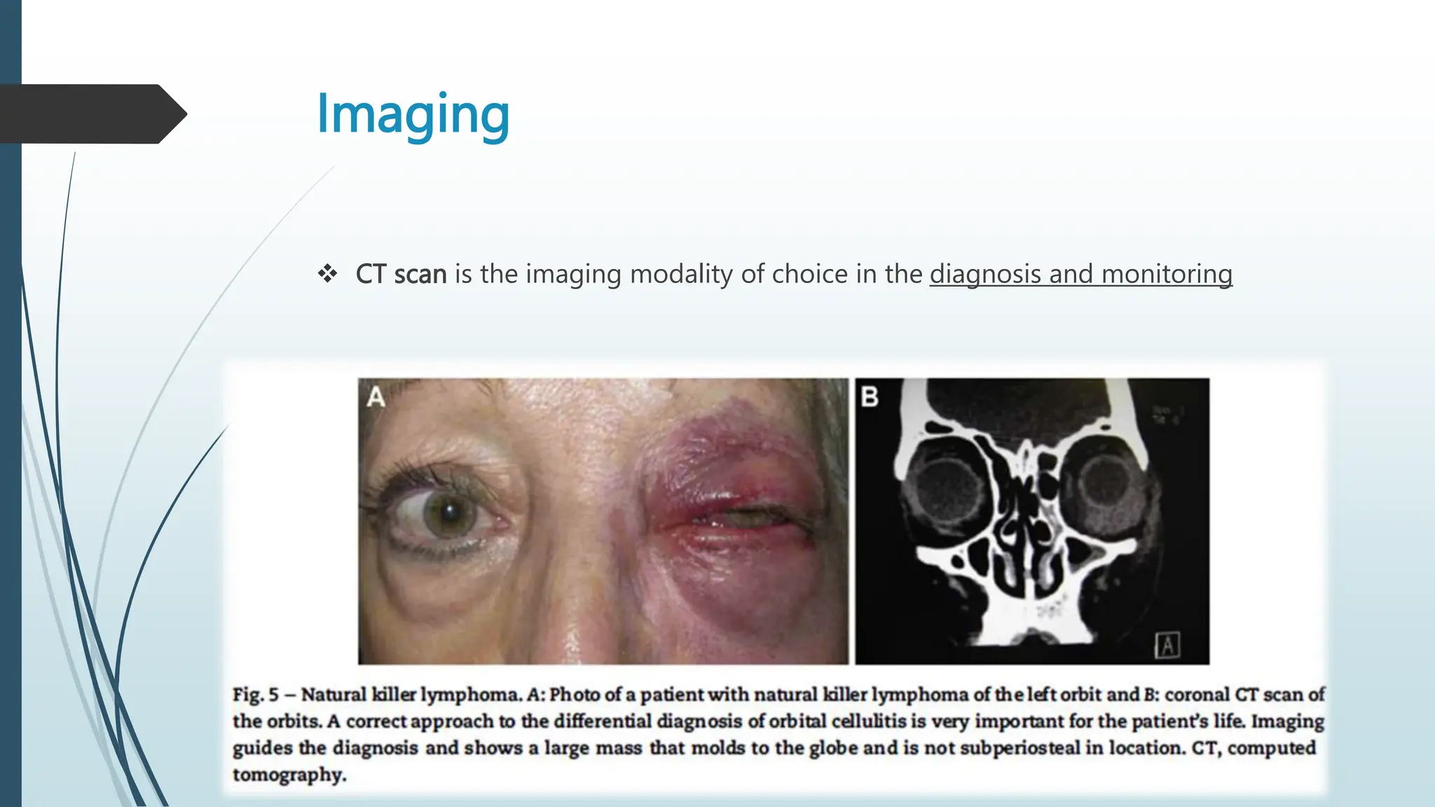 Orbital cellulitis 2.pptx