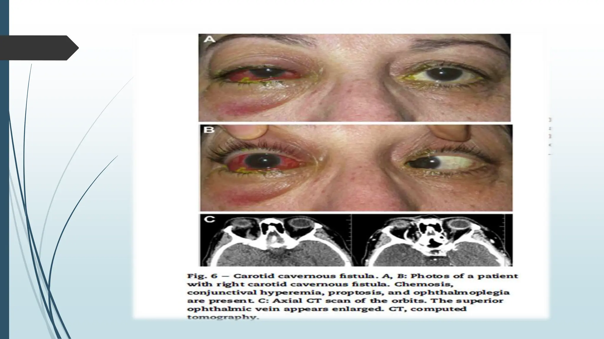 Orbital cellulitis 2.pptx
