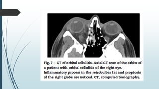 Orbital cellulitis 2.pptx
