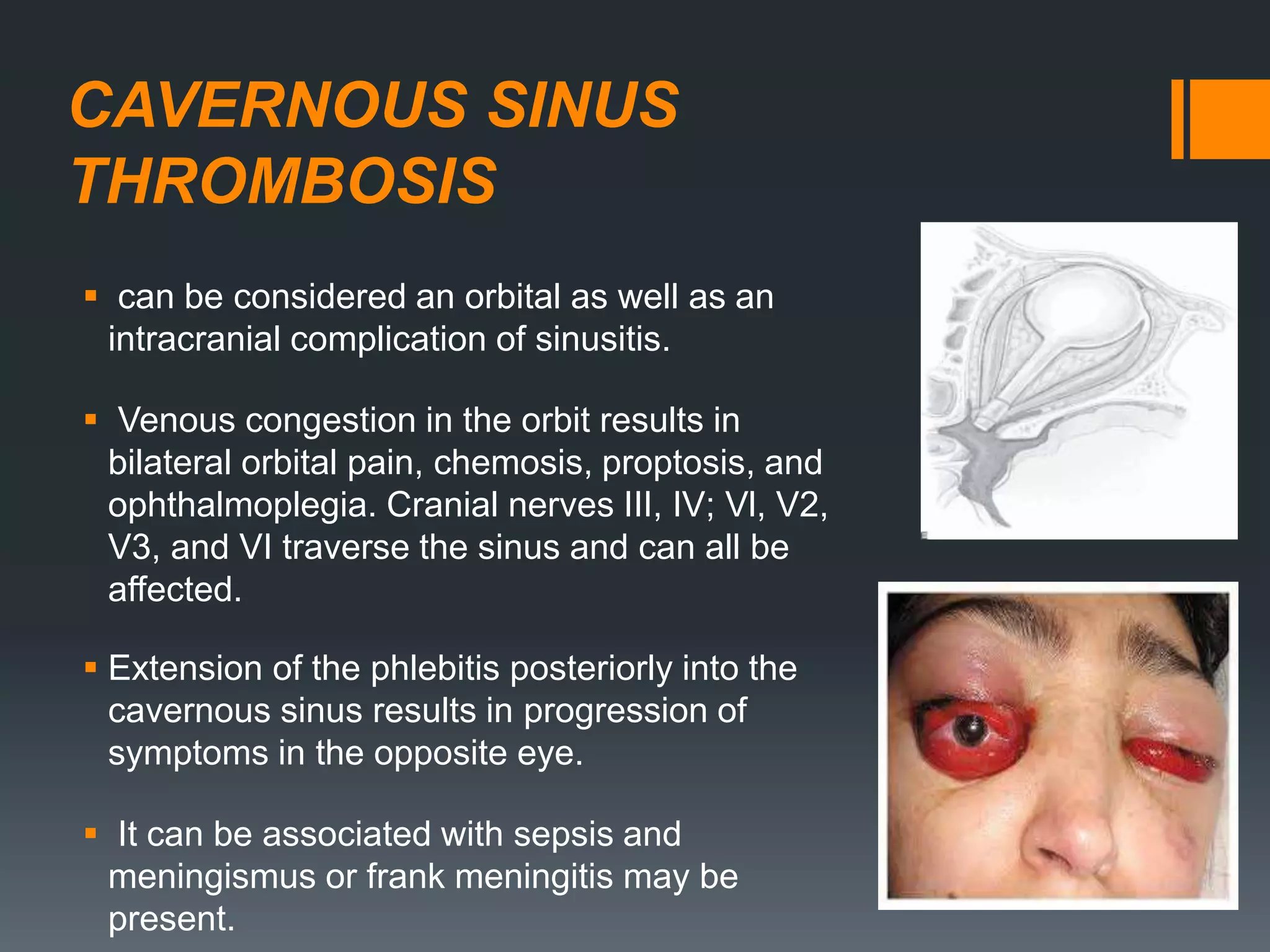 Orbital complications of acute Rhinosinusitis | PPTX