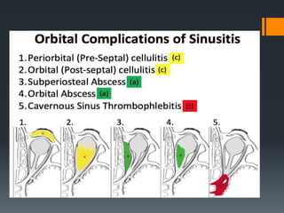 Orbital complications of acute Rhinosinusitis | PPTX