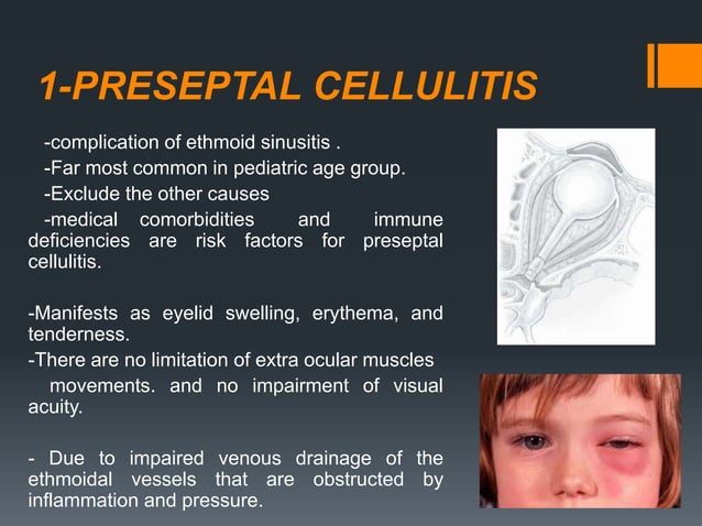 Orbital complications of acute Rhinosinusitis | PPTX