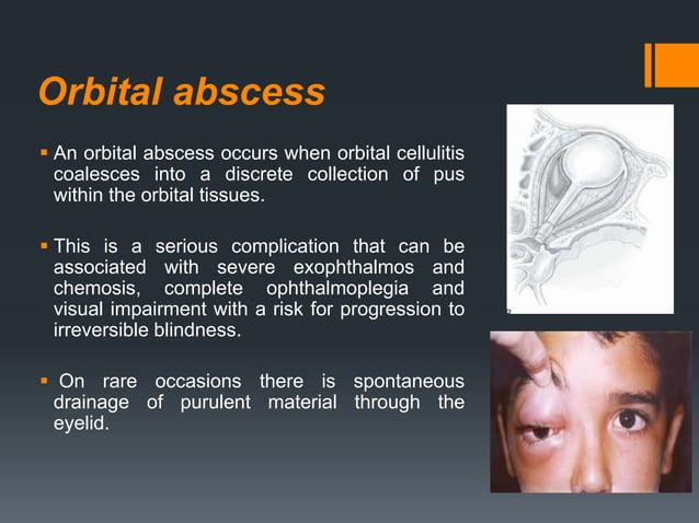 Orbital complications of acute Rhinosinusitis | PPTX