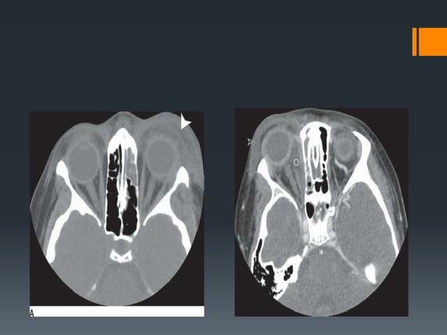 Orbital complications of acute Rhinosinusitis | PPTX