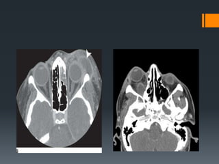Orbital complications of acute Rhinosinusitis | PPTX