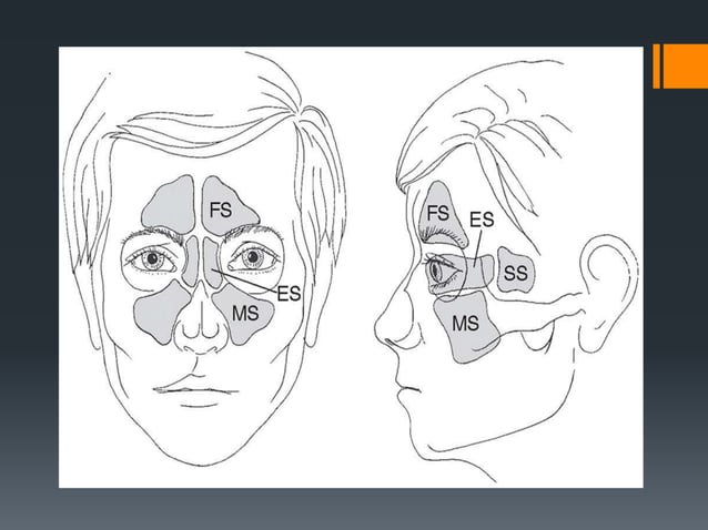 Orbital complications of acute Rhinosinusitis | PPTX