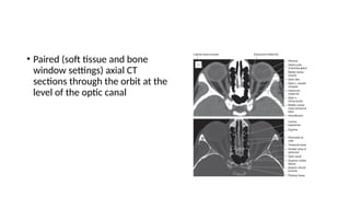 Orbital contents and eyeballgvhGGJAyWiwgwkwyyuwyw | PPTX