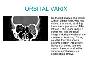 Orbital ct and mr | PPT