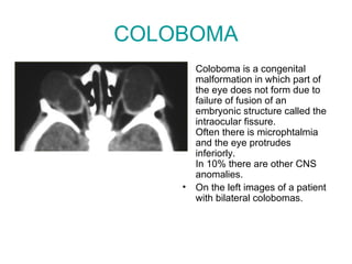 Orbital ct and mr | PPT | Thyroid Disorders | Endocrine and Metabolic ...