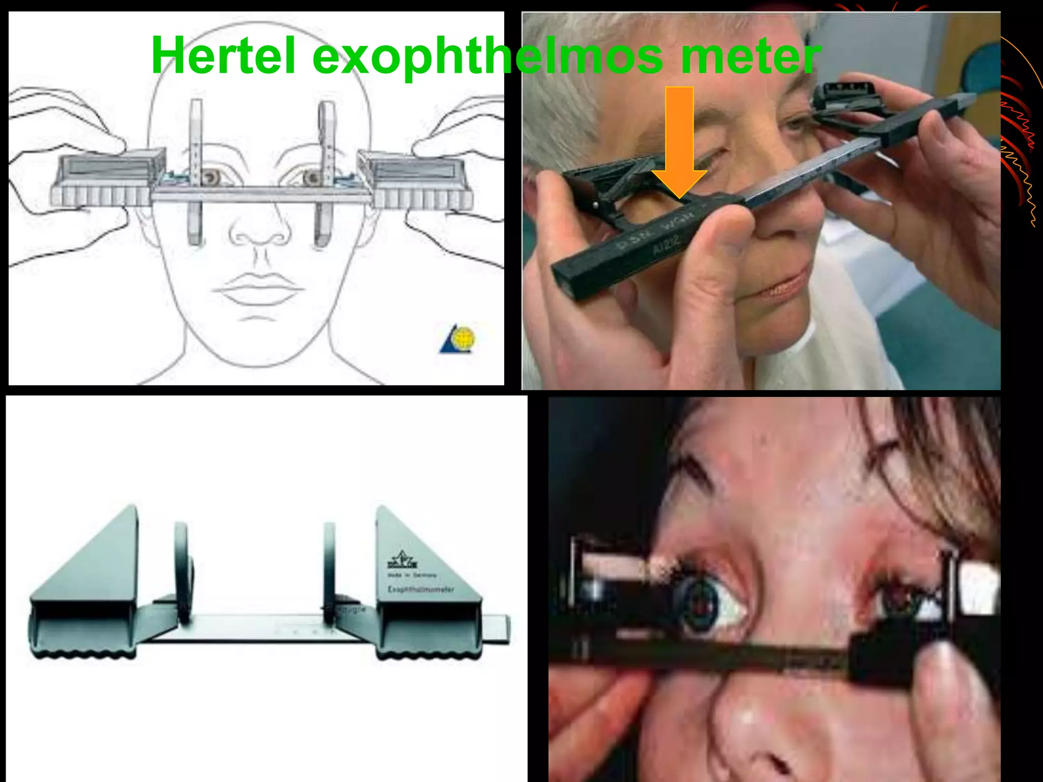 Orbital disaese lec by dr abdul basir safi | PDF