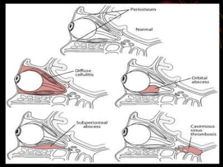 Orbital disaese lec by dr abdul basir safi | PDF