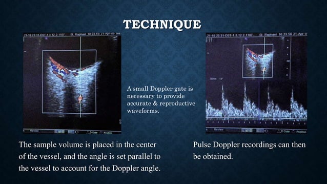 ORBITAL DOPPLER .pptx