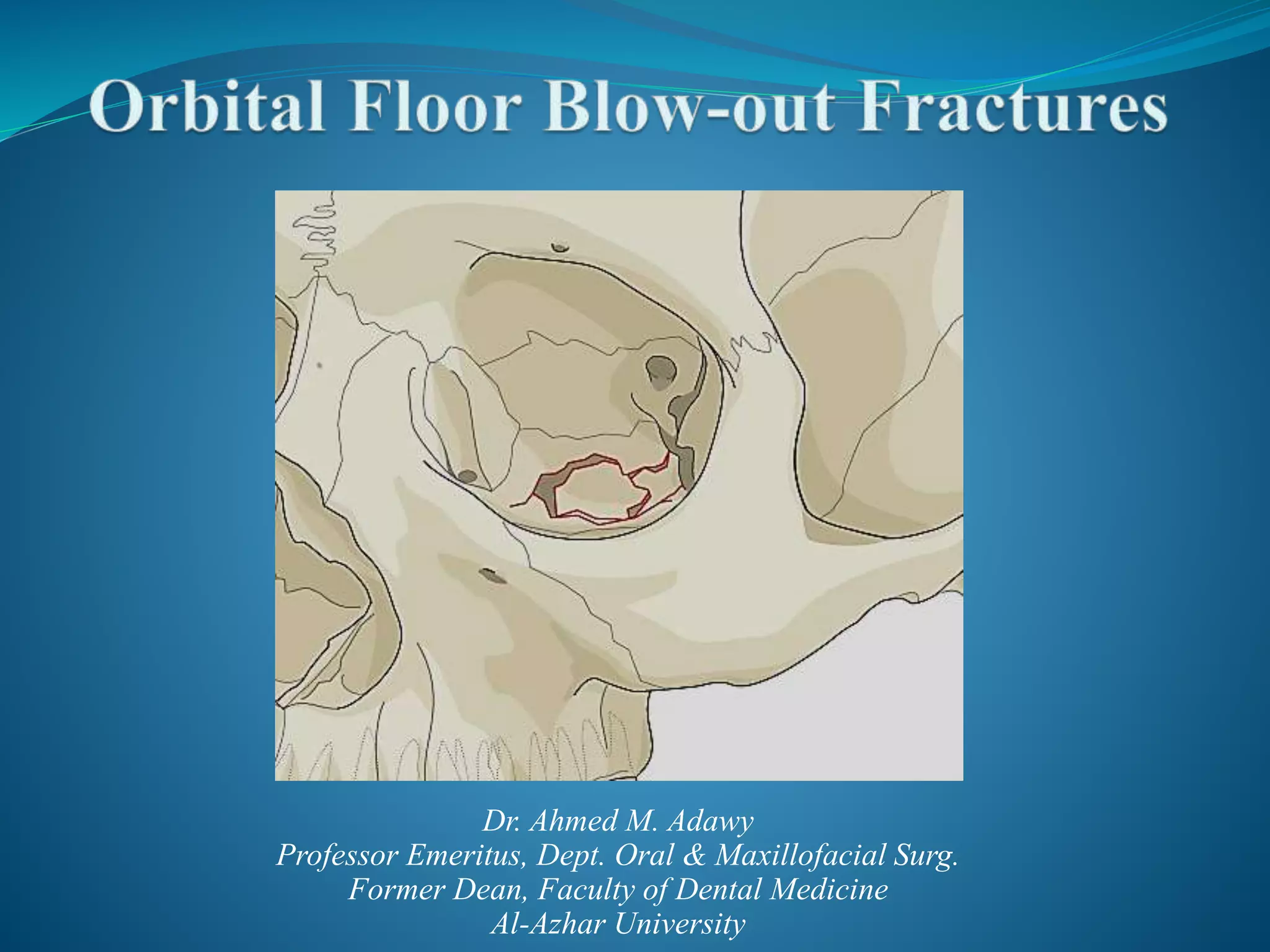Orbital Floor Blow Out Fractures Pptx