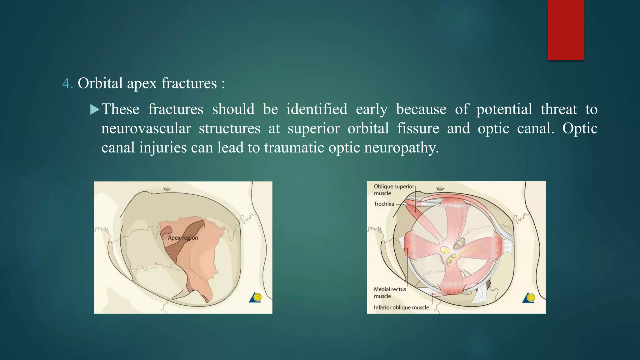 Orbital fracture | PPTX