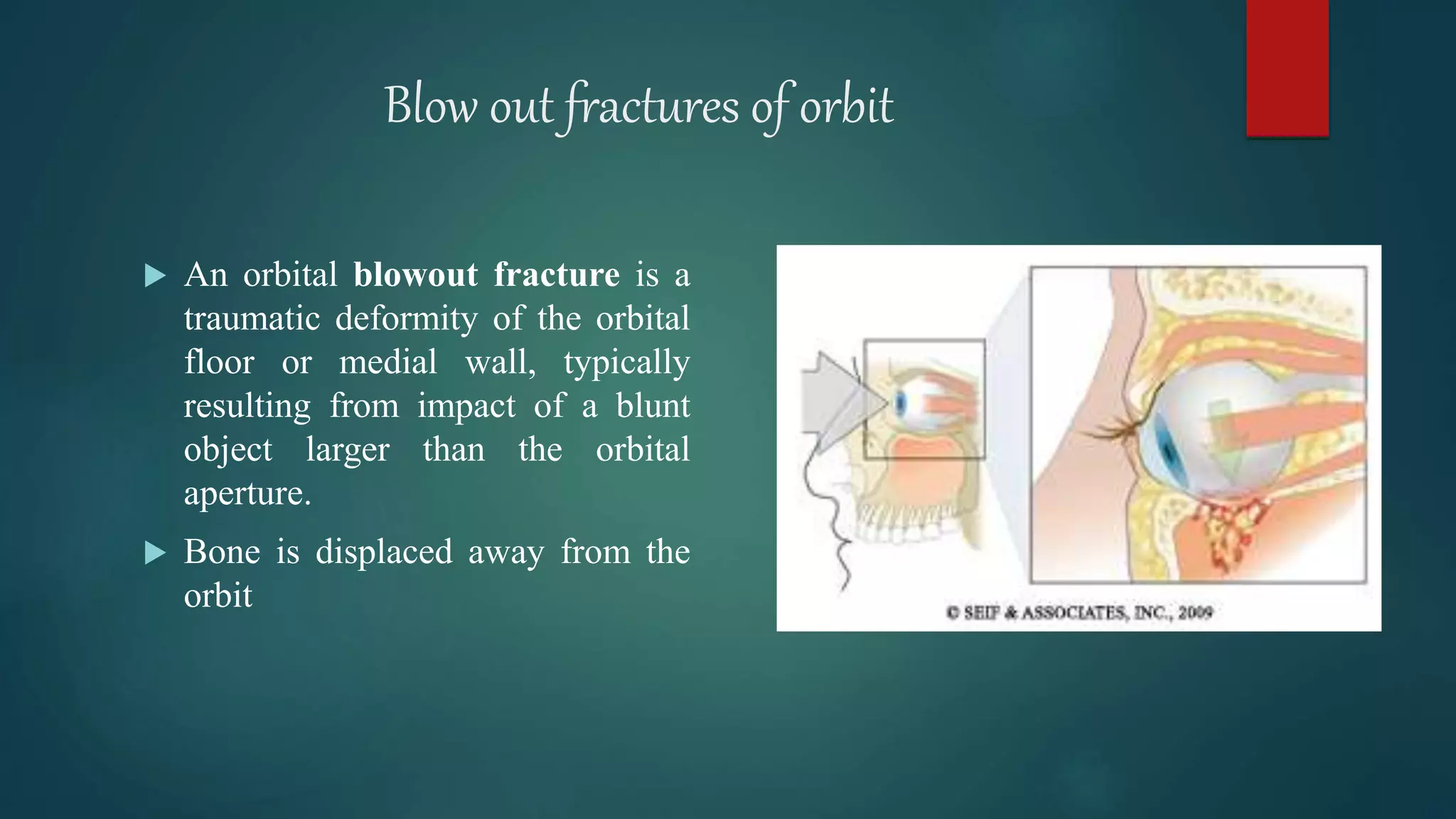 Orbital fracture | PPTX