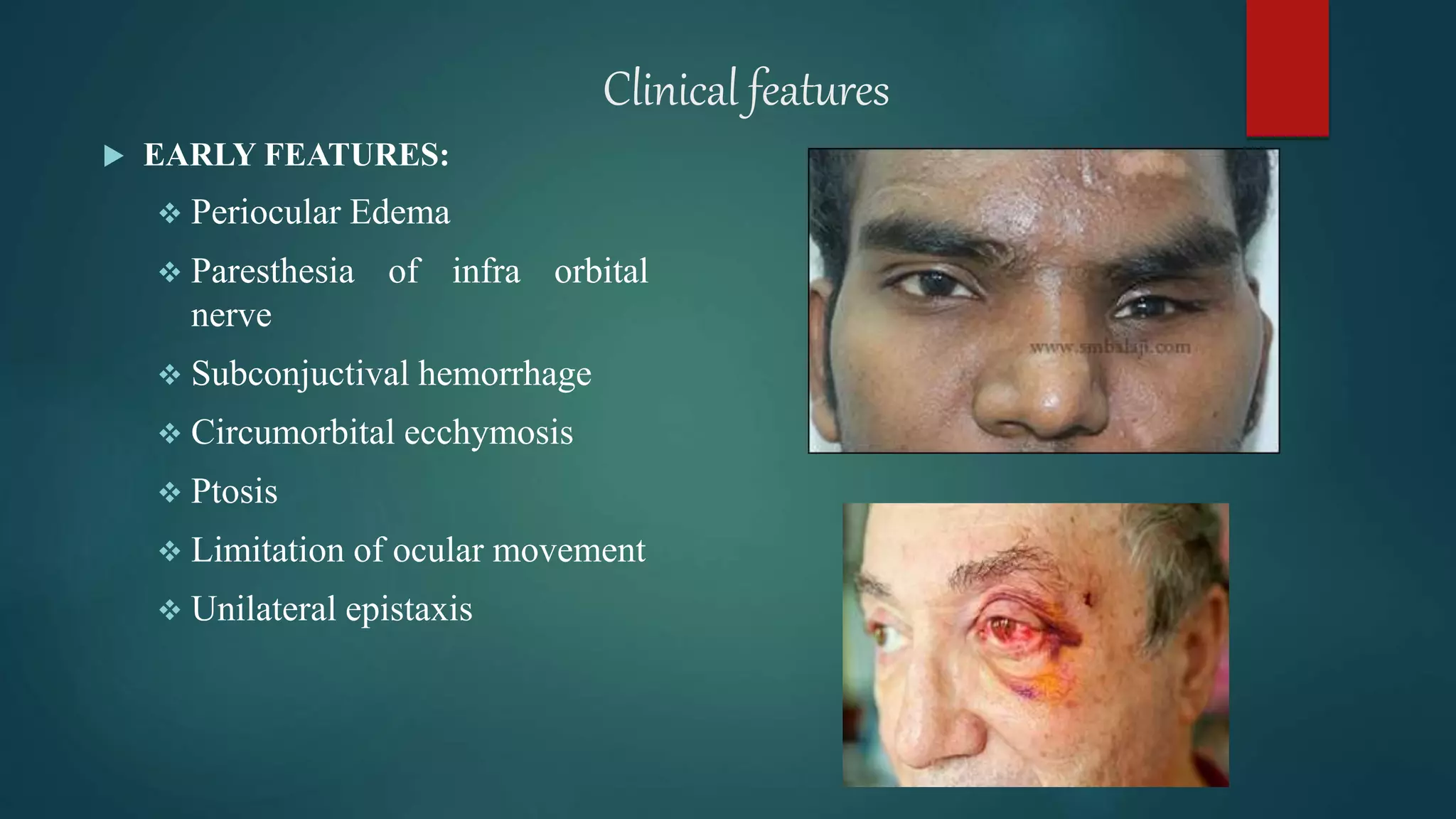 Orbital Fracture Pptx
