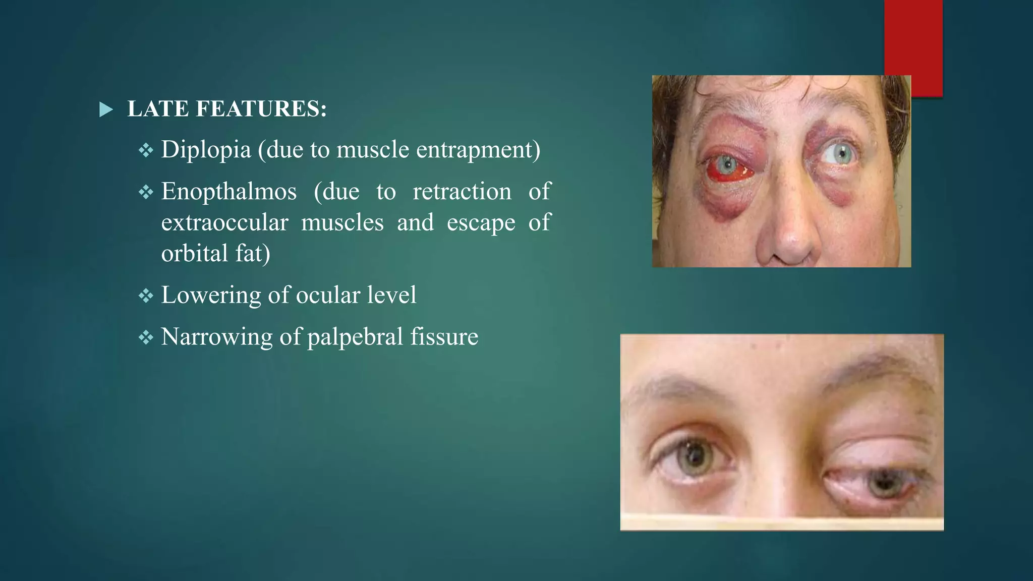 Orbital fracture | PPTX