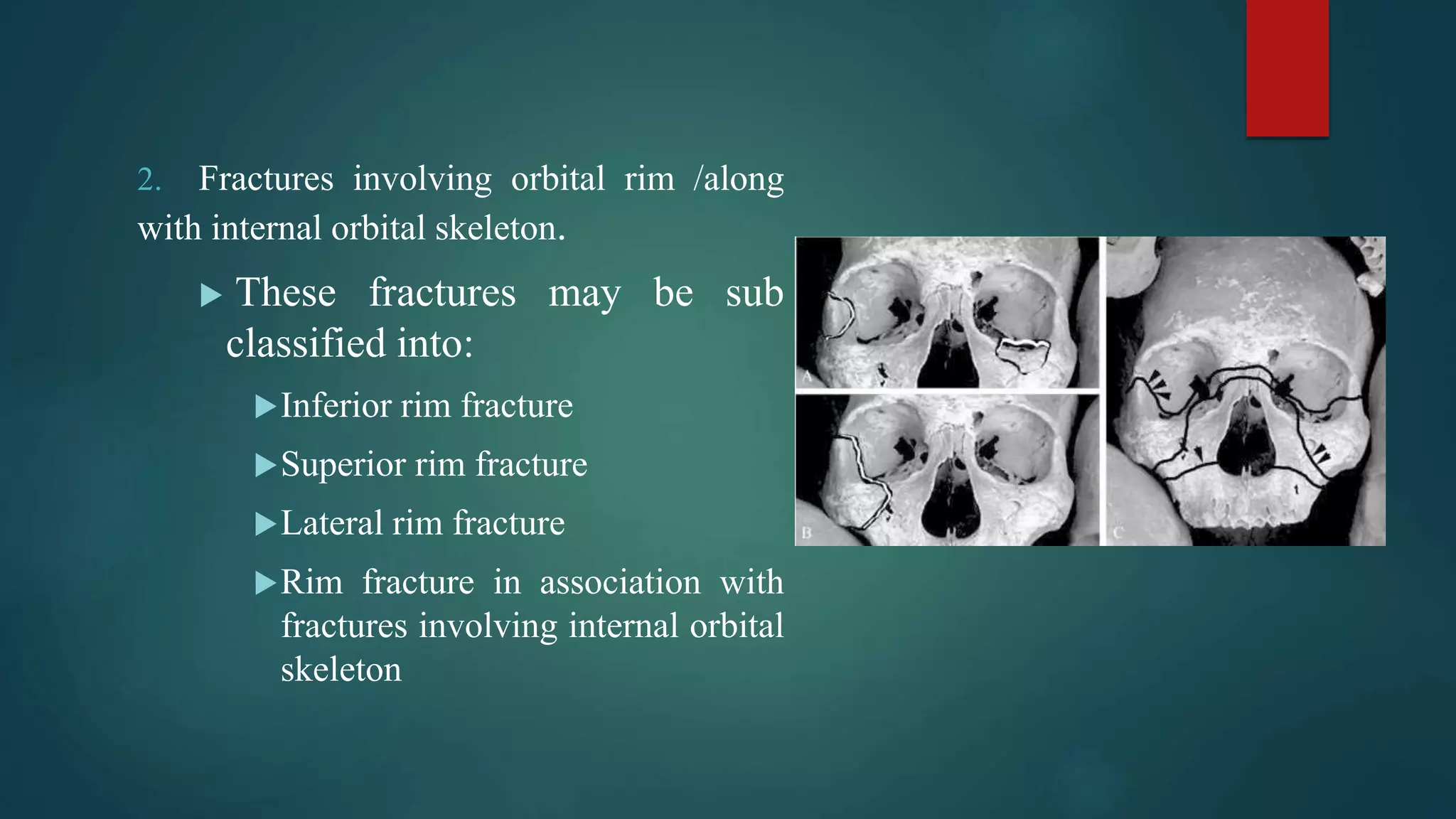 Orbital fracture | PPTX