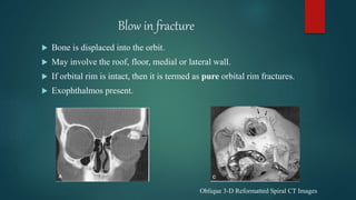 Blow Out Fracture