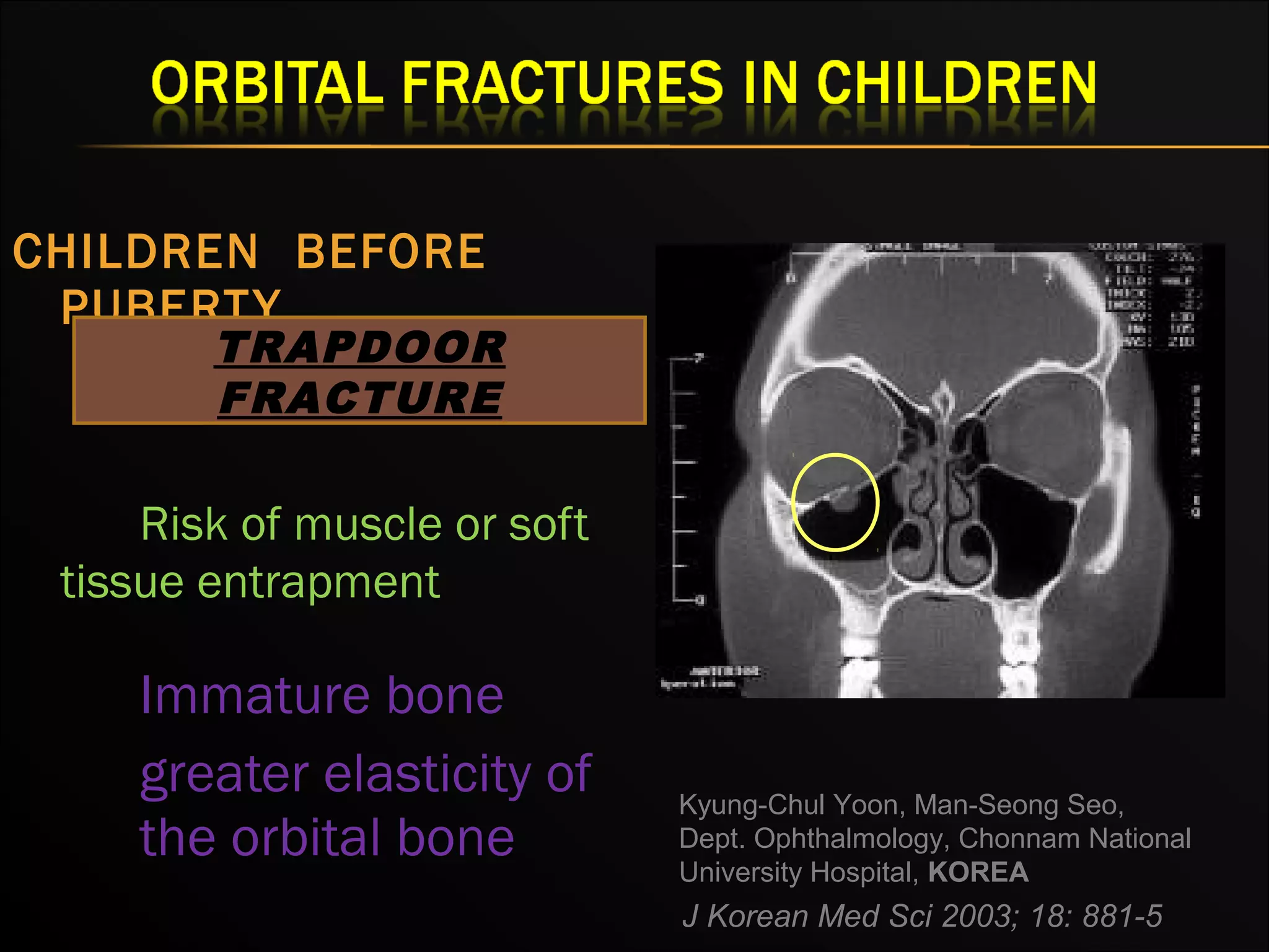 Orbital fracture | PPT
