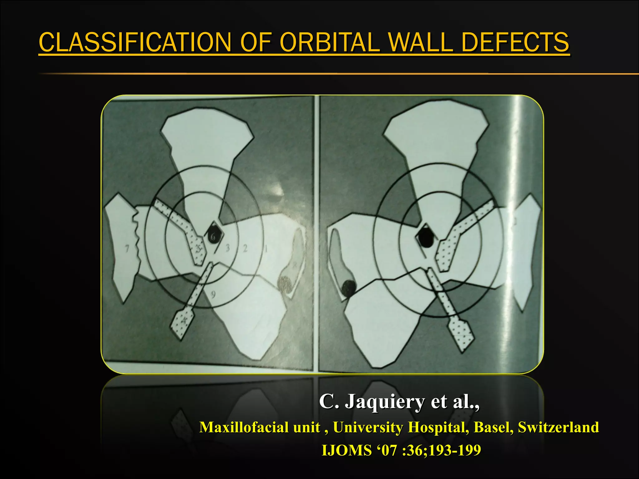 Orbital fracture | PPT