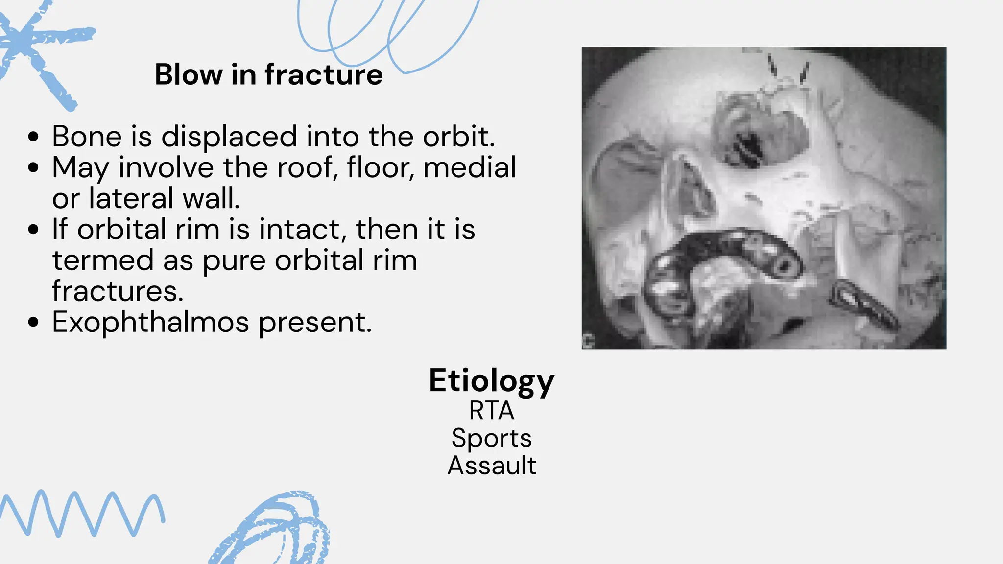 Orbital fracture, anatomy , surgical aproch | PDF