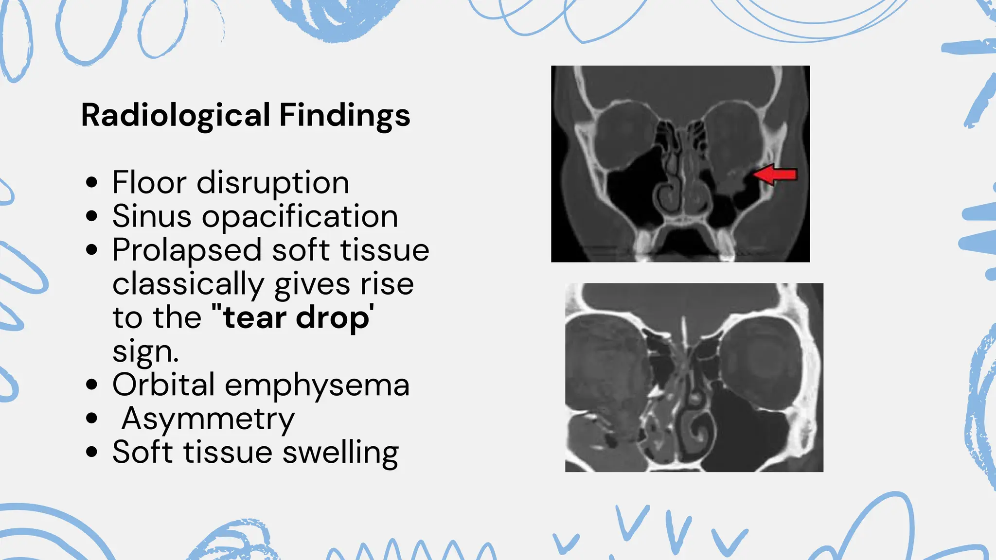 Orbital fracture, anatomy , surgical aproch | PDF