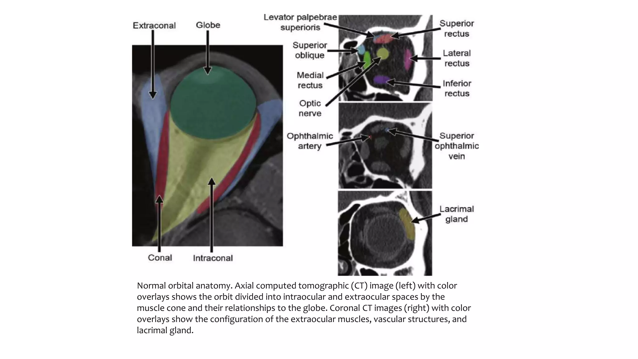 Orbital fracture management | PPTX