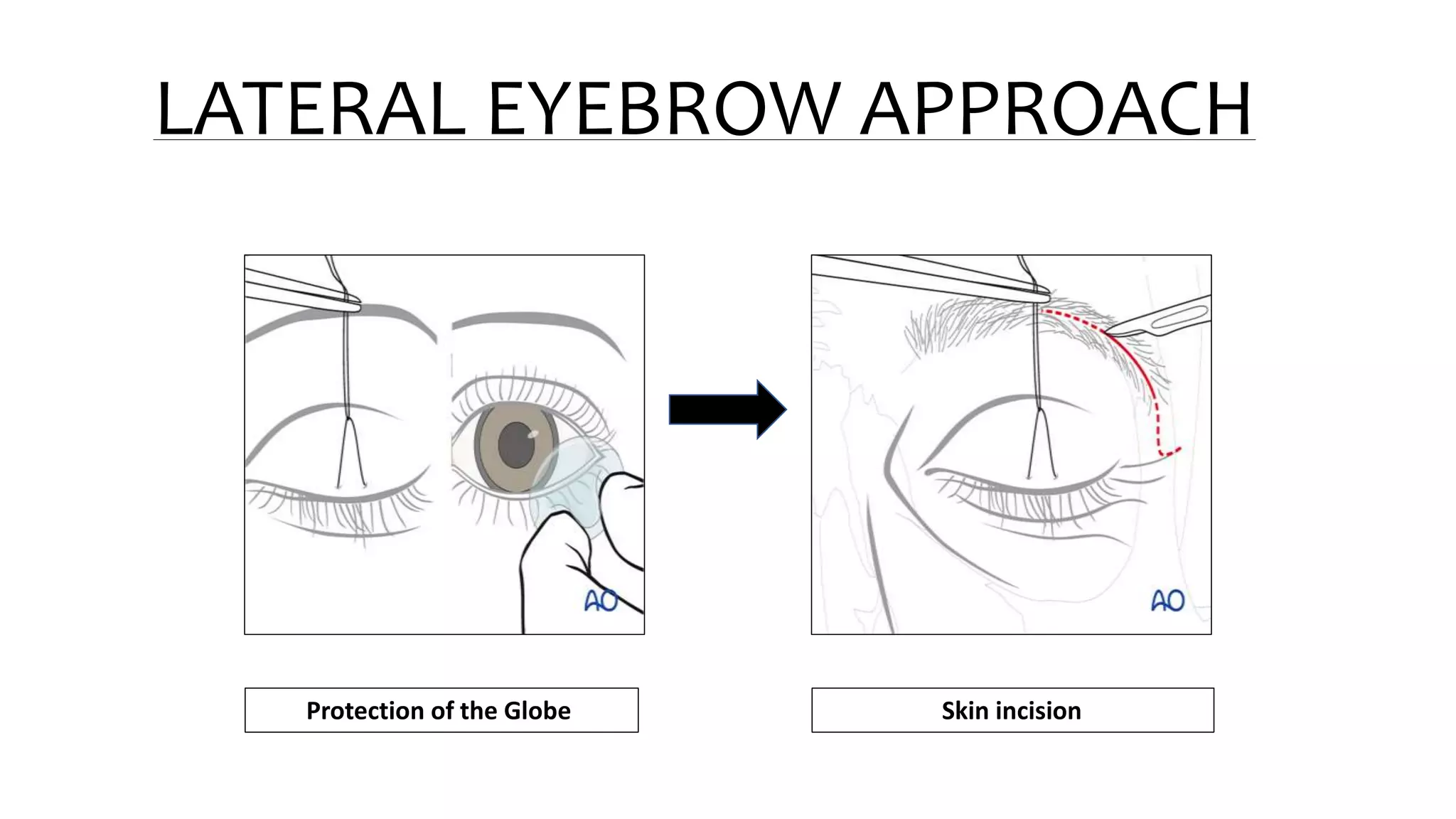 Orbital fracture management | PPTX