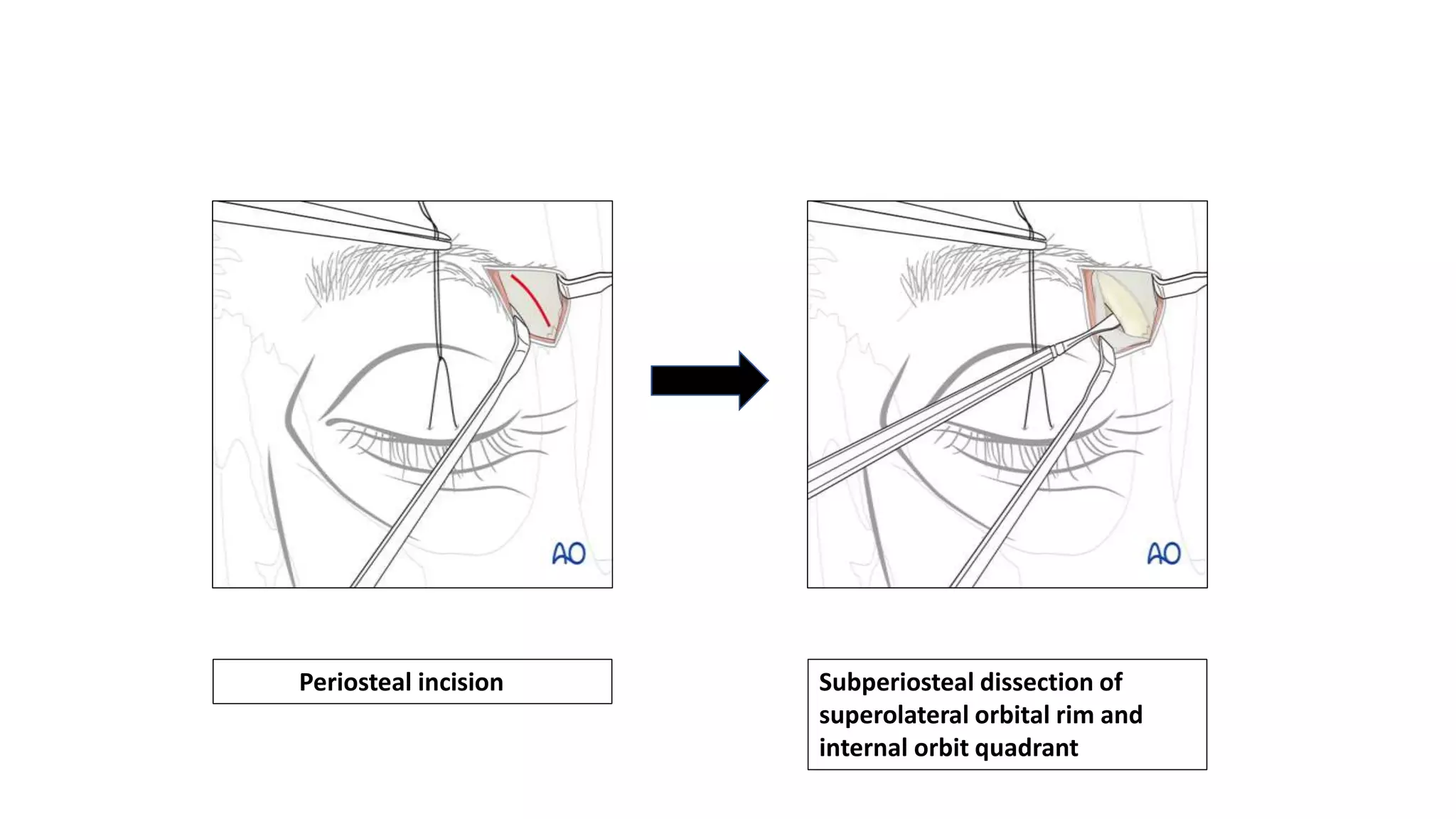 Orbital fracture management | PPTX