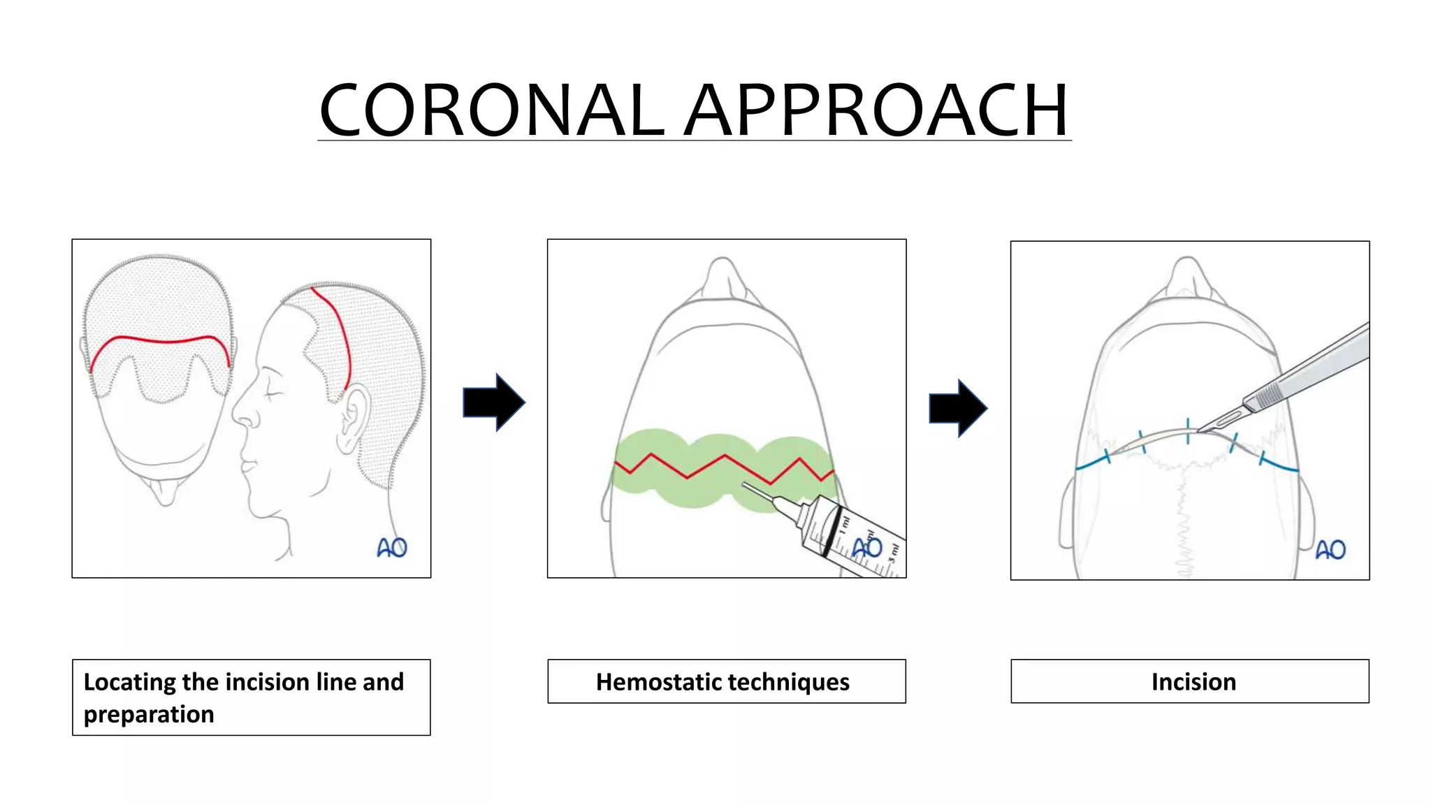 Orbital fracture management | PPTX
