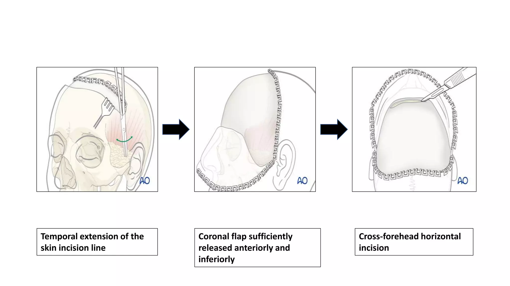 Orbital fracture management | PPTX