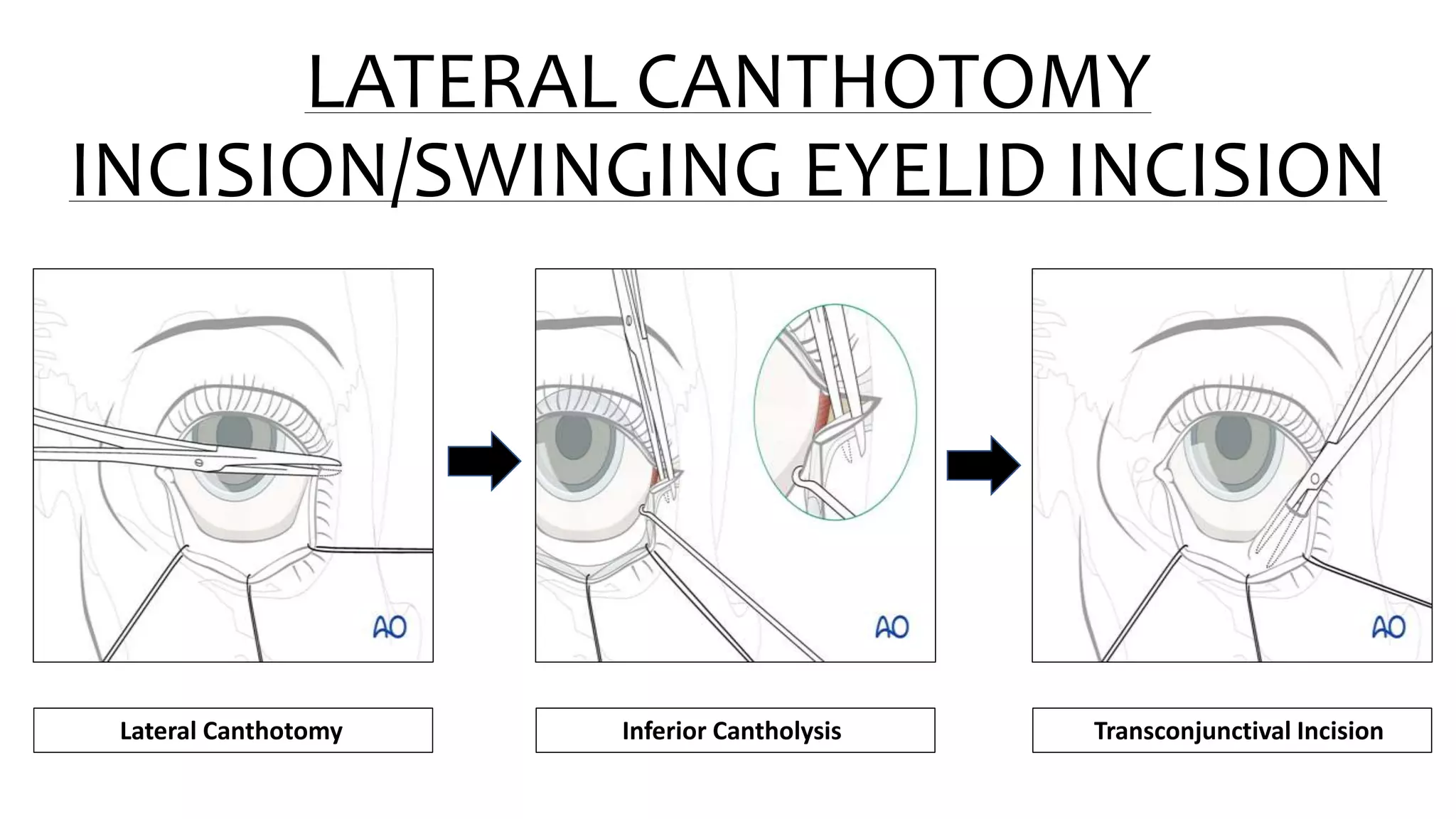 Orbital fracture management | PPTX