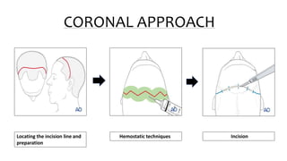 Orbital fracture management | PPTX