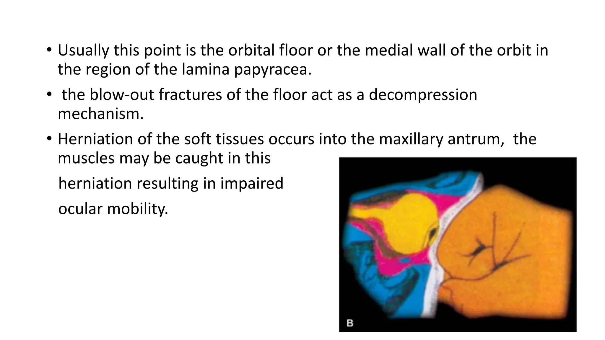 ORBITAL FRACTURES.pptx