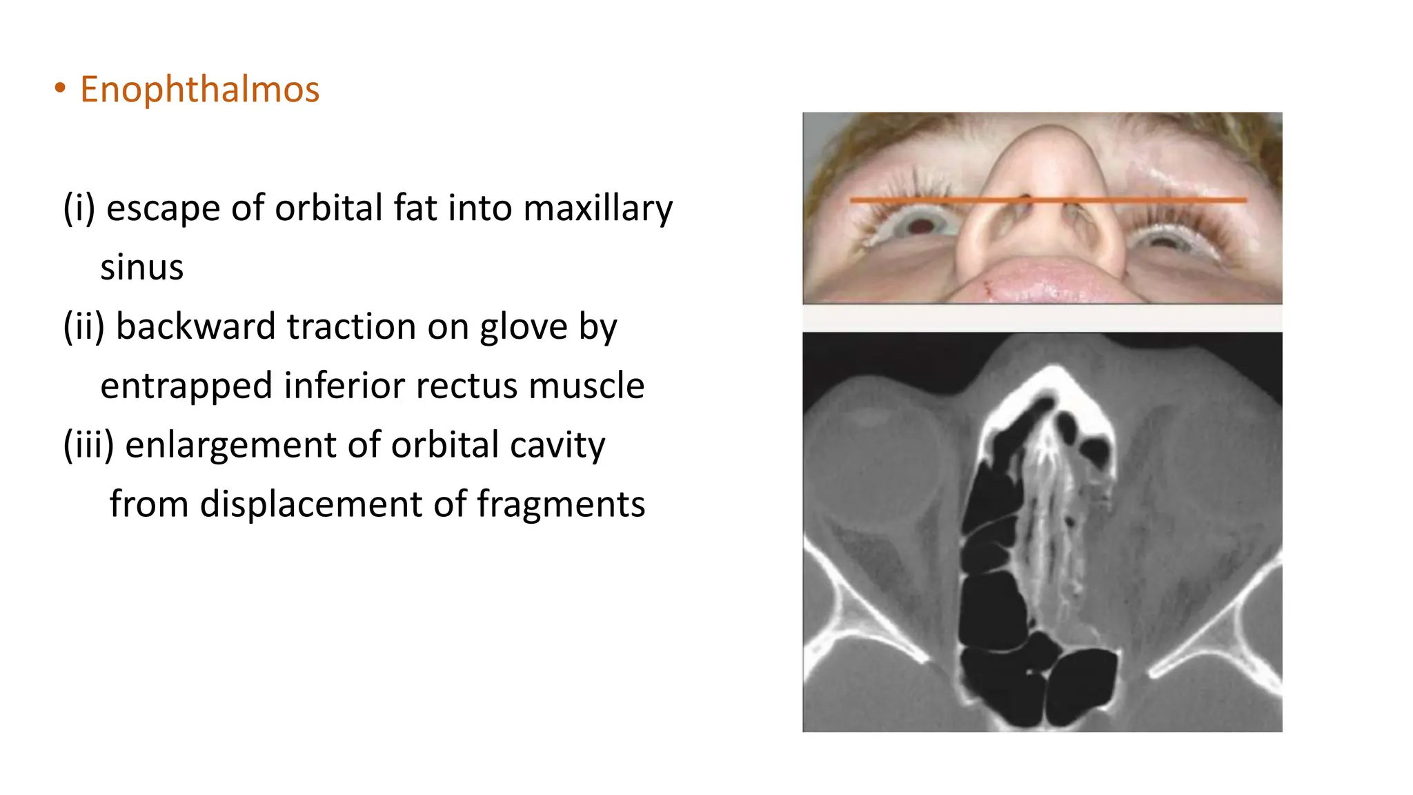 ORBITAL FRACTURES.pptx