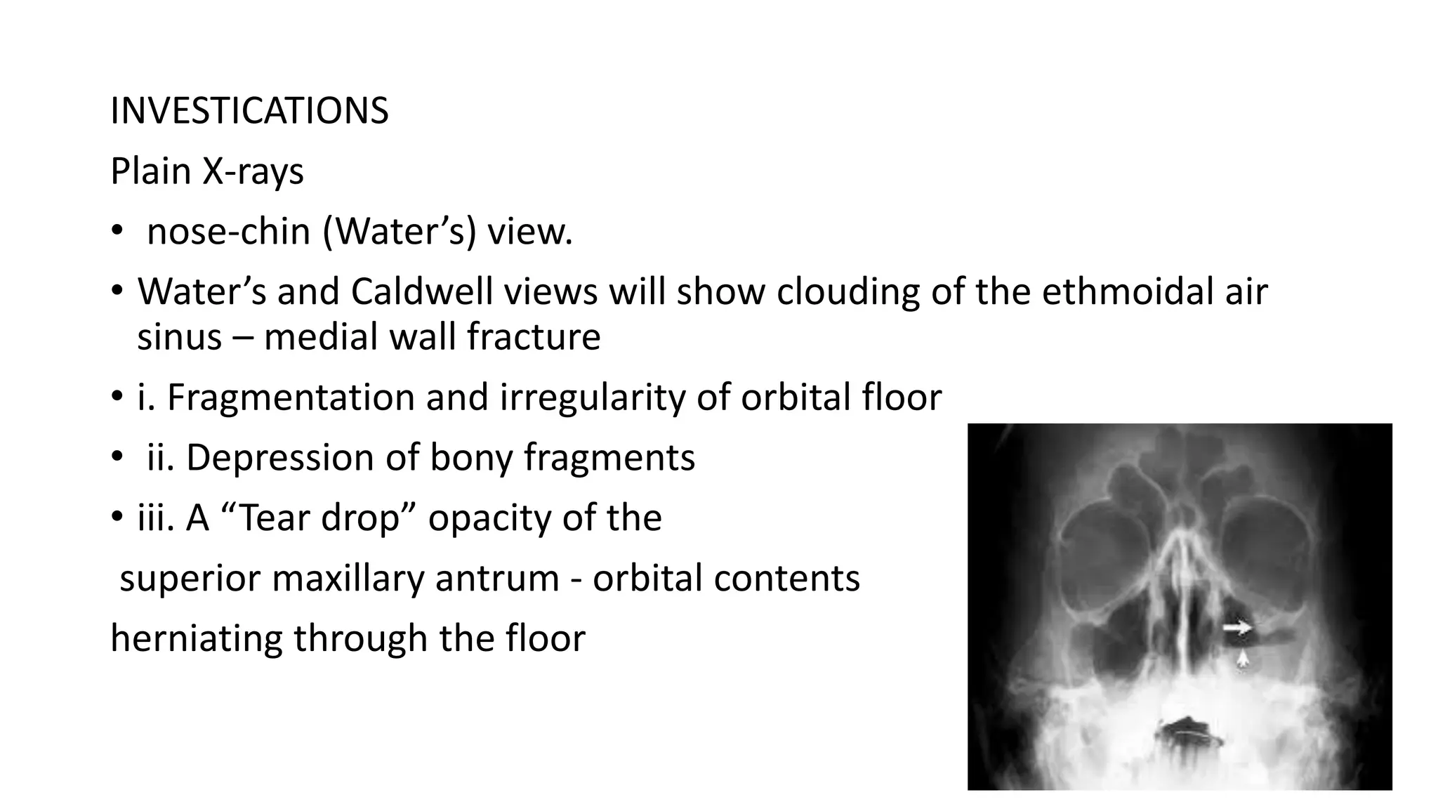 ORBITAL FRACTURES.pptx