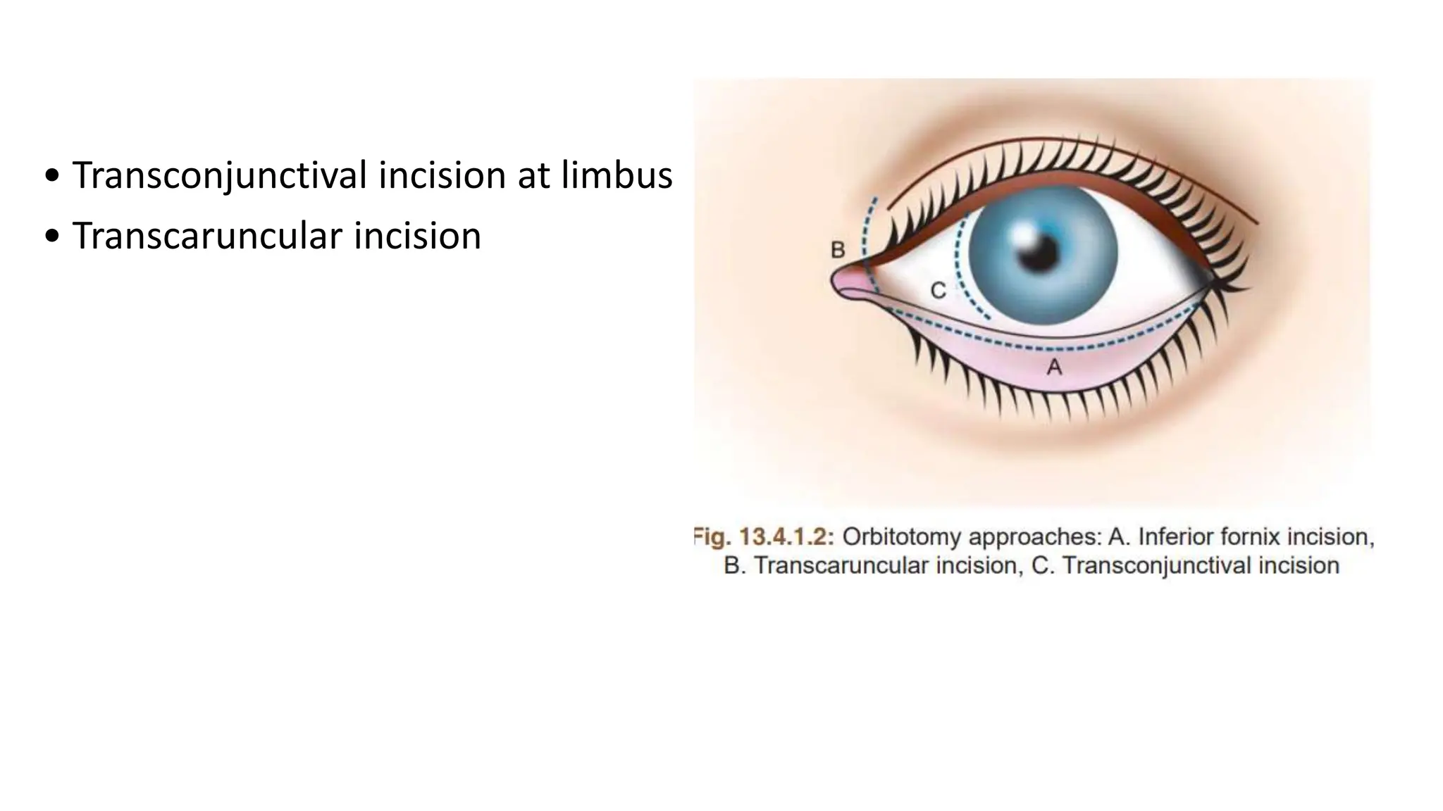 ORBITAL FRACTURES.pptx