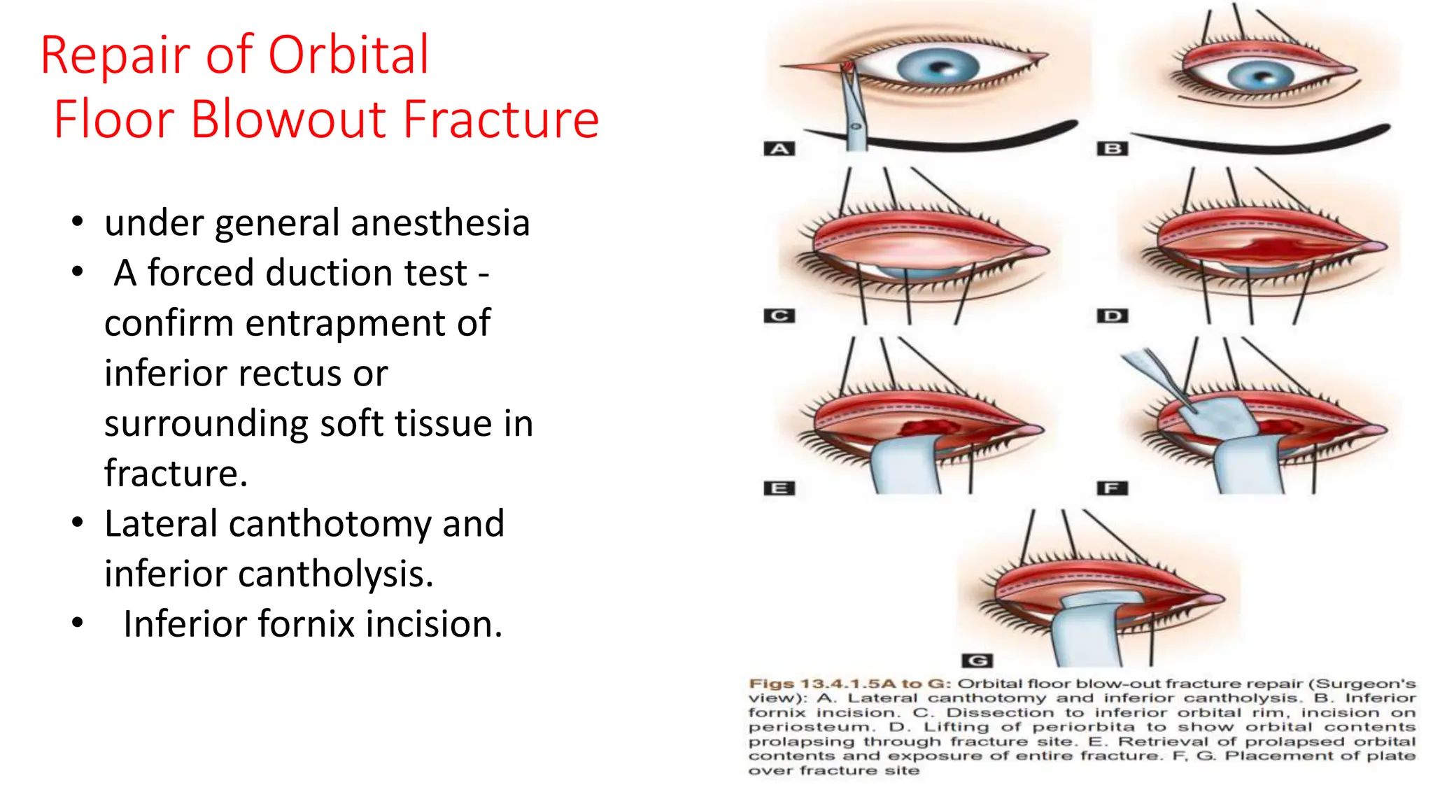 ORBITAL FRACTURES.pptx