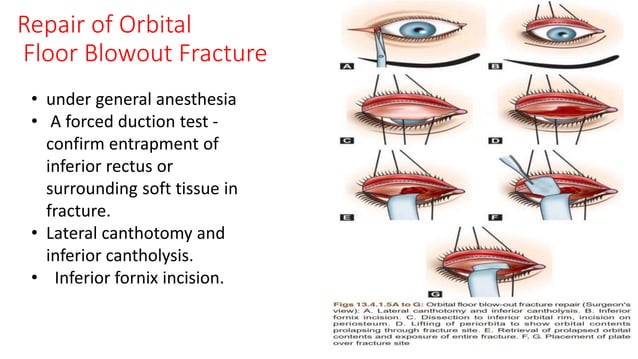 ORBITAL FRACTURES.pptx
