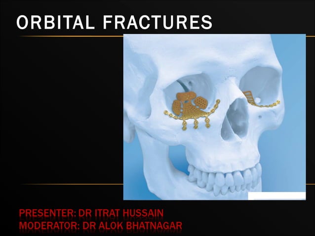 Orbital fractures ih | PPT